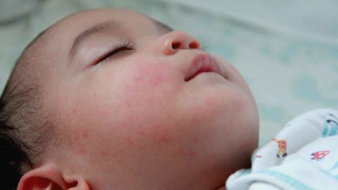 macam macam dermatitis Archives - SensiCare